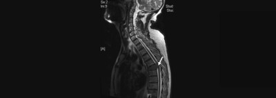 Síndrome de Compresión Medular – MICASAEMIS